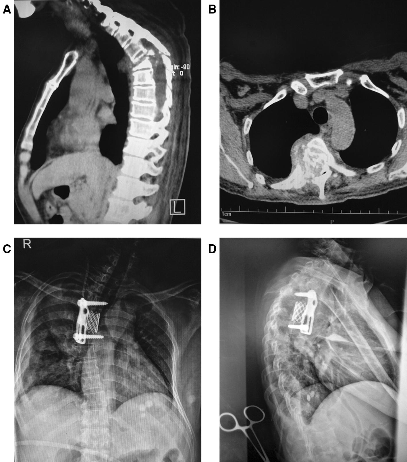 Right infraaxillary thoracotomy approach for upper thoracic vertebral ...