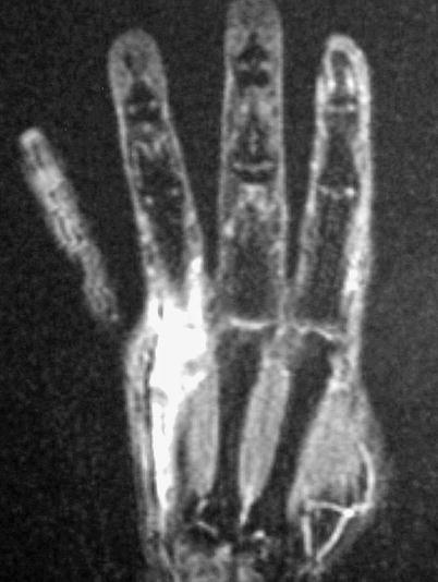 Late complications after a palm thorn injury to the hand | SpringerLink