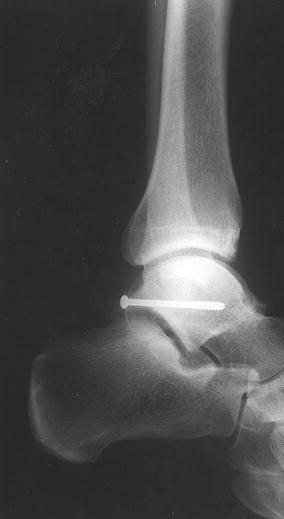 Fracture of the posterior process of the talus: a case report ...