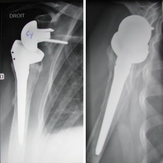 Delta III reverse-ball-and-socket total shoulder prosthesis for acute ...