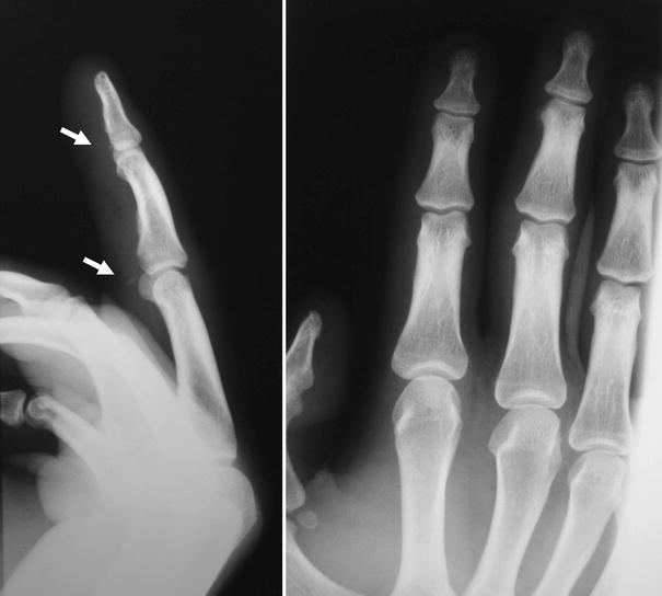 Simultaneous dislocation of the both interphalangeal joints in the ...