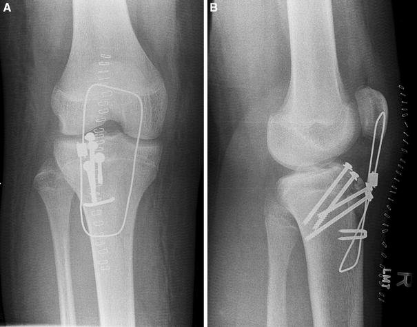 Avulsion fracture of tibial tuberosity with simultaneous contralateral ...