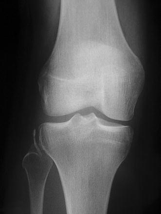Is the Segond’s fracture a reliable sign of anterior cruciate ligament ...