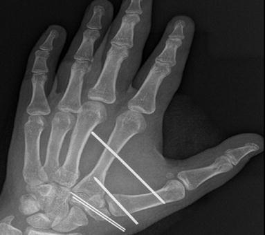 Fracture of trapezium with trapeziometacarpal subluxation | SpringerLink