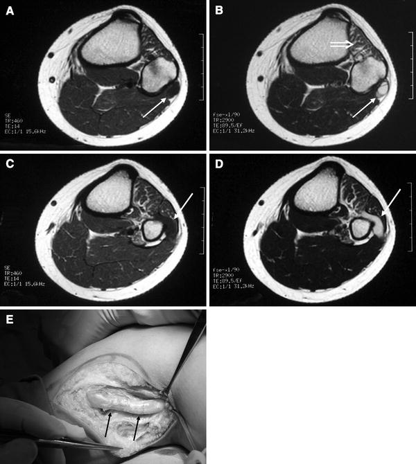 Intraneural ganglion: review of the literature | SpringerLink