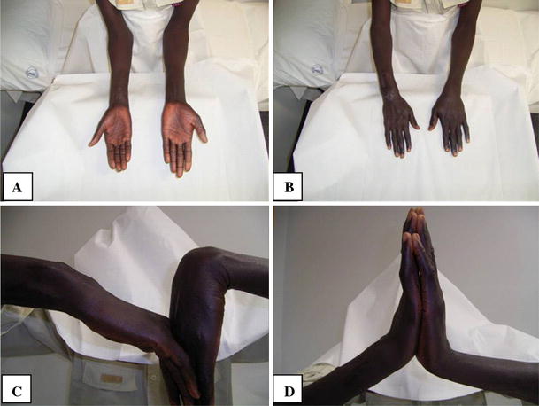 Darrach's ulnar resection and ulna intercalary bone graft for non-union ...