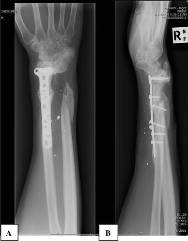 Darrach's ulnar resection and ulna intercalary bone graft for non-union ...