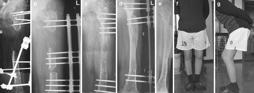 Femoral bone transport by a monolateral external fixator with or ...
