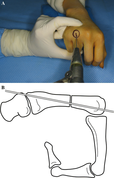 Modified retrograde percutaneous intramedullary multiple Kirschner wire ...
