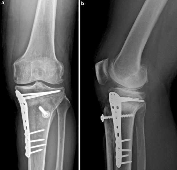Combined medial open-wedge high tibial osteotomy and modified Maquet ...