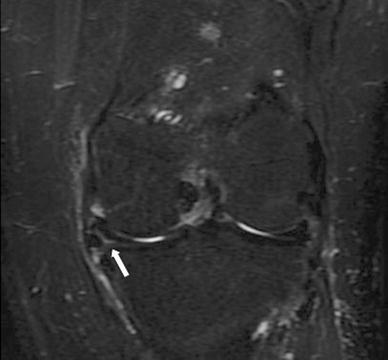 Knee sonography as a diagnostic test for medial meniscal tears in young ...