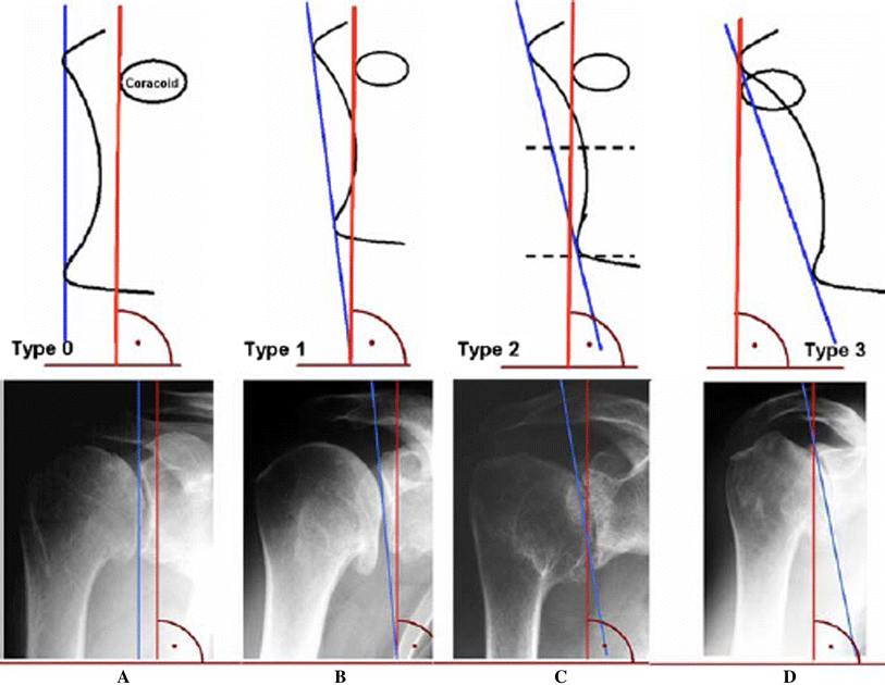 Morphology of the normal and arthritic glenoid | SpringerLink