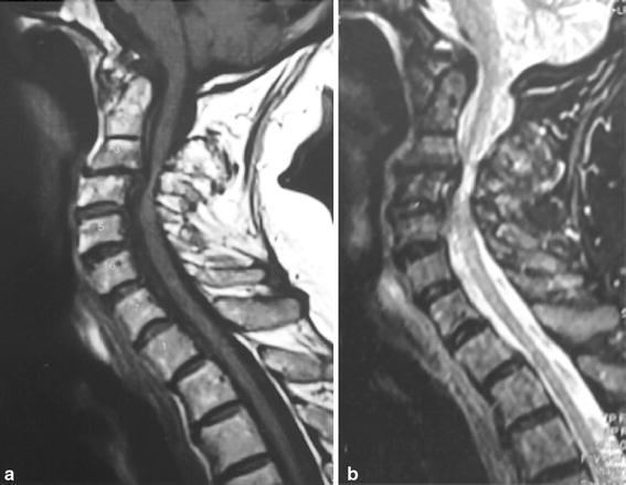 Congenital variations of the upper cervical spine and their importance ...