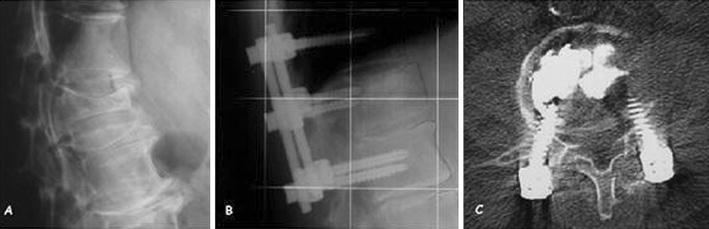 Transpedicular vertebral body augmentation reinforced with pedicle ...