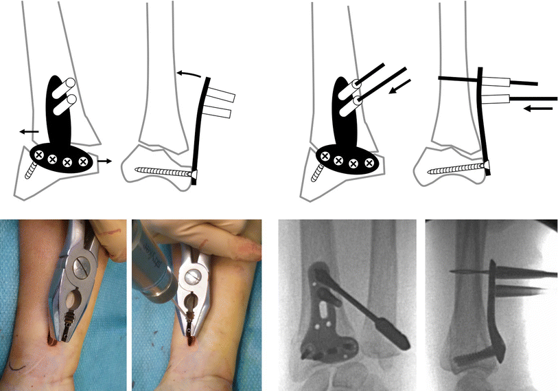 Distal radius fixation through a mini-invasive approach of 15 mm. PART ...