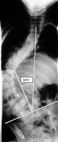 Correction of severe pelvic obliquity using maximum-width segmental ...