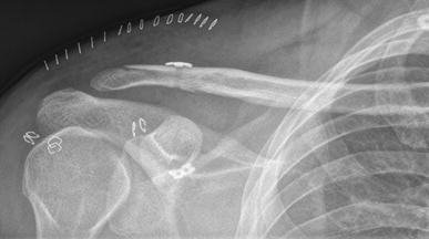 TightRope versus clavicular hook plate fixation for unstable distal ...