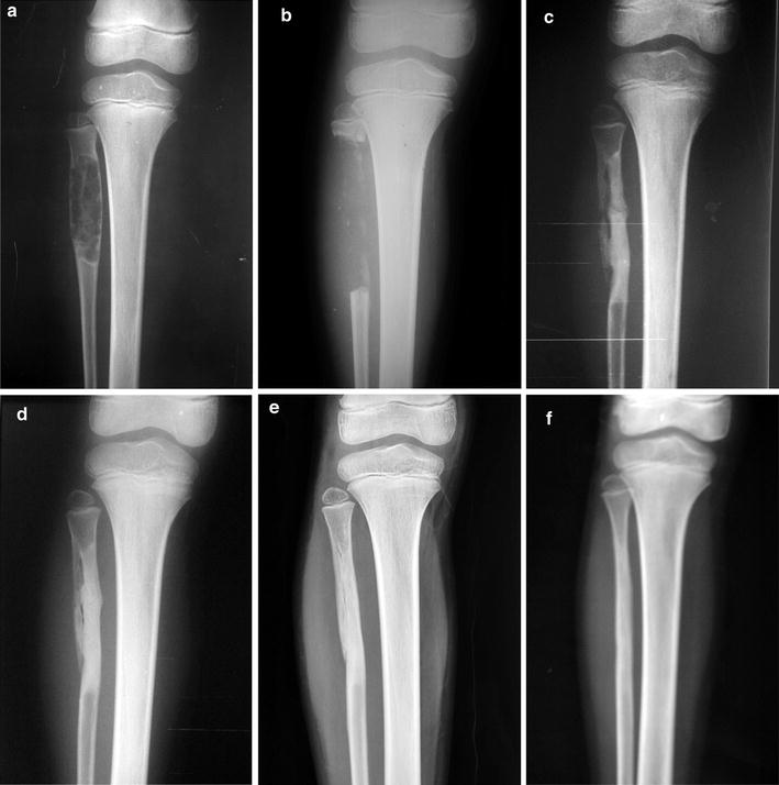 Subperiosteal resection of fibular aneurysmal bone cyst | SpringerLink