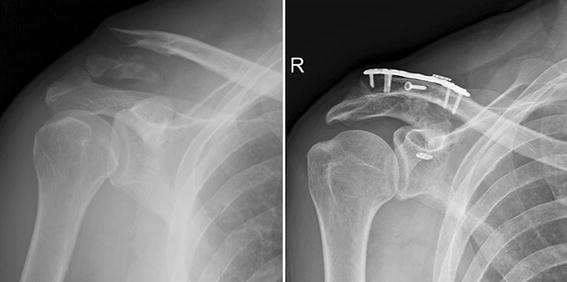 Anatomic locking plate and coracoclavicular stabilization with suture ...