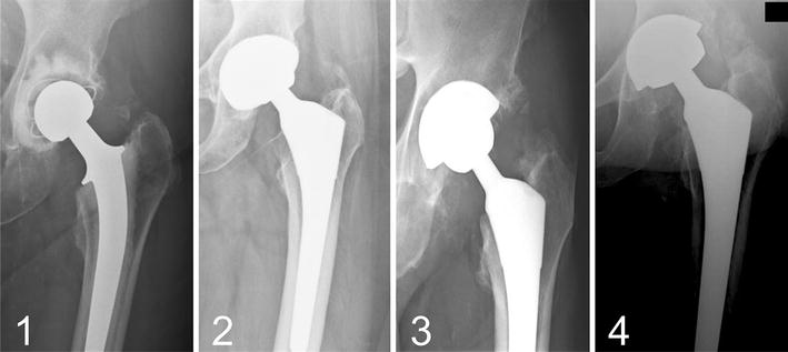 Posterior mini-incision total hip arthroplasty controls the extent of ...
