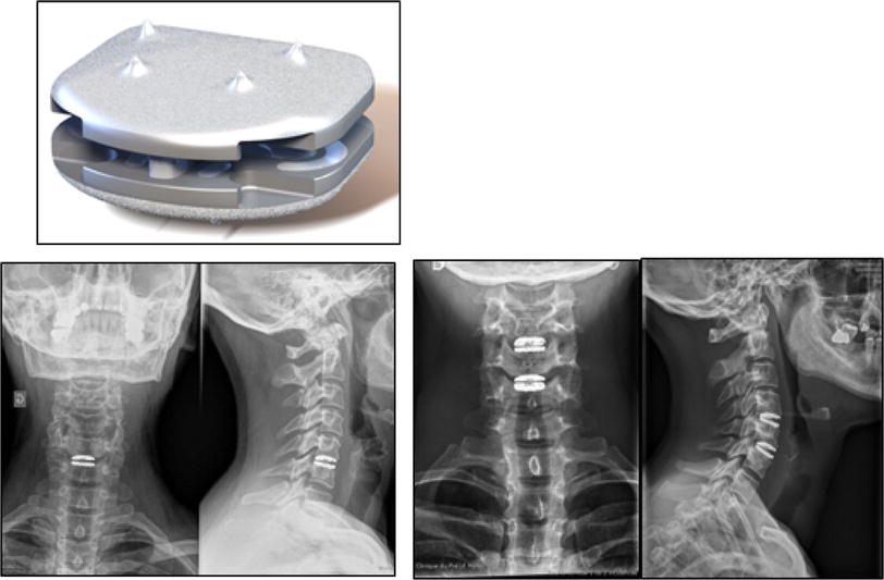 The innovative viscoelastic CP ESP cervical disk prosthesis with six ...