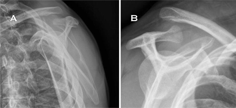 Management of acute unstable acromioclavicular joint injuries ...
