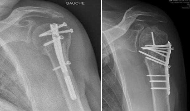Shoulder arthroscopy combined to hardware removal in proximal humeral ...