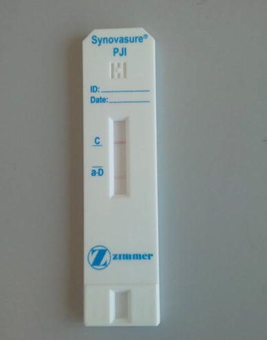 False-positive synovial fluid alpha-defensin test in a patient with ...