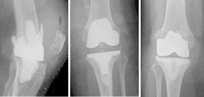 Two-stage revision surgery for infected total knee replacements ...