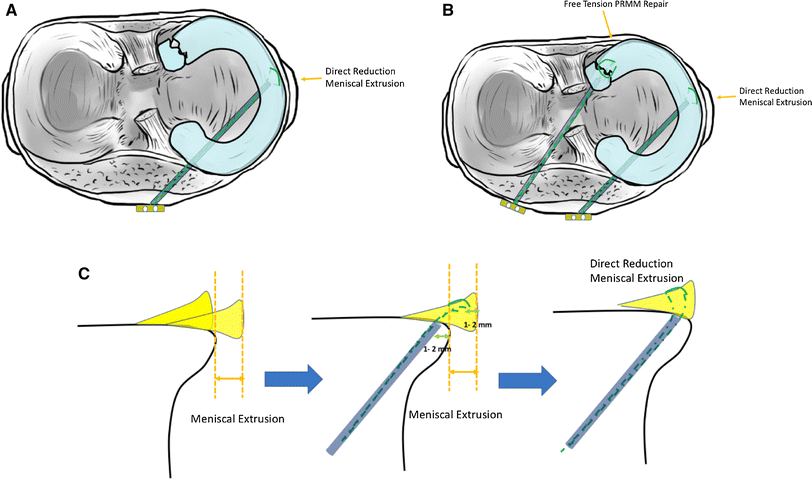 Arthroscopic direct meniscal extrusion reduction: surgical tips to ...