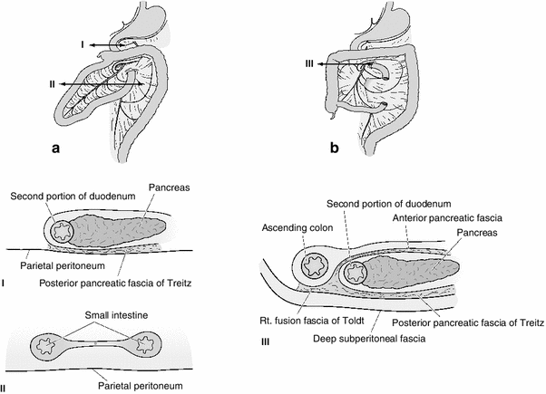 Laparoscopic surgery for colon cancer: a review of the fascial ...