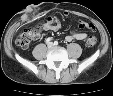 Parastomal hernia repair with the Sugarbaker technique using e-PTFE ...