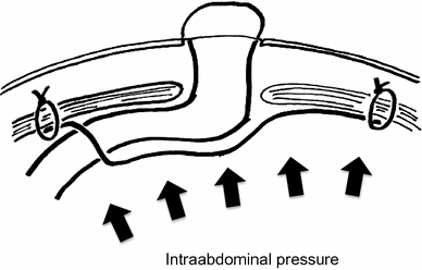 Parastomal hernia repair with the Sugarbaker technique using e-PTFE ...