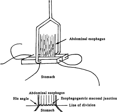 Surgical techniques to prevent reflux esophagitis in proximal ...