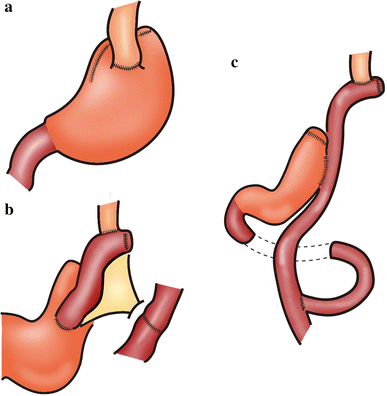 Laparoscopic proximal gastrectomy for early gastric cancer | SpringerLink