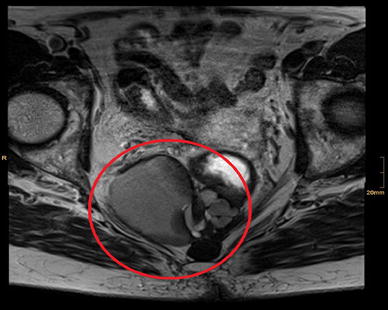 Treatment of tailgut cysts by extended distal rectal segmental ...