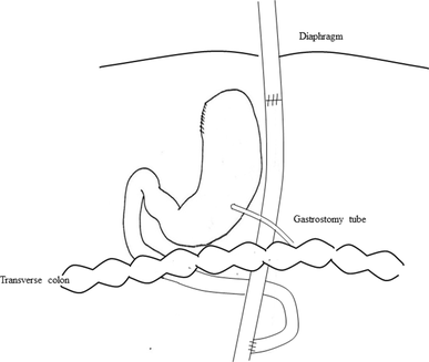 Indications for total esophagogastric dissociation in children with ...