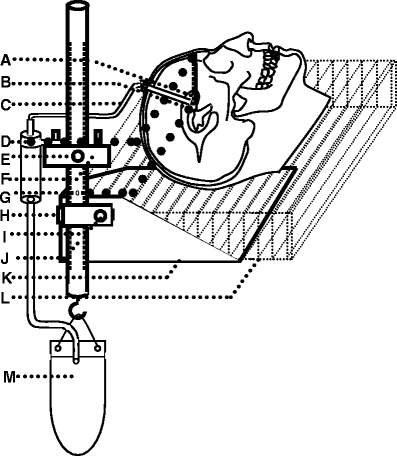 Mounting device for external cerebrospinal fluid drainage: the Freiburg ...