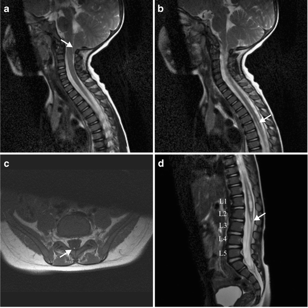 Concurrent Chiari decompression and spinal cord untethering in children ...