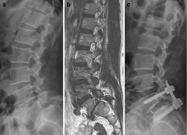 Failed anterior lumbar interbody fusion due to incomplete foraminal ...