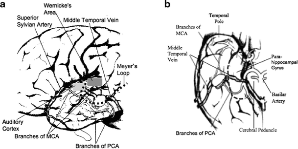 Resection of lateral temporal lobe arteriovenous malformations ...