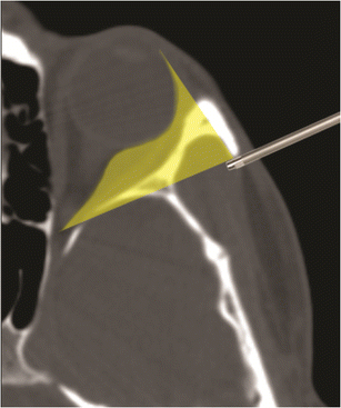 Endoscopic lateral orbitotomy | SpringerLink
