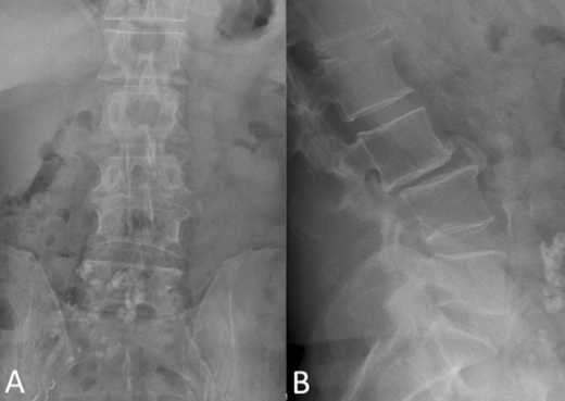 Extreme lateral interbody fusion (XLIF®): how I do it | SpringerLink