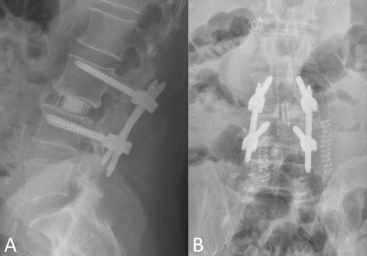 Extreme lateral interbody fusion (XLIF®): how I do it | SpringerLink