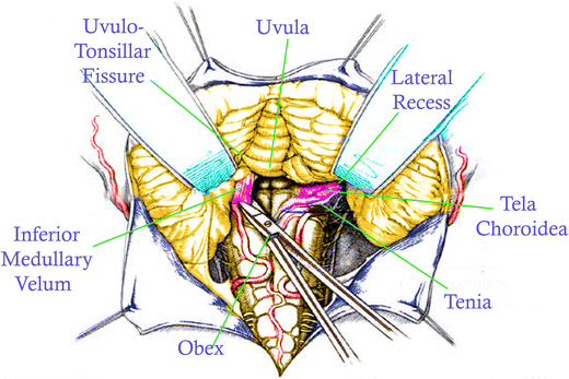 Telo-velar approach to fourth-ventricle tumours: how I do it | SpringerLink