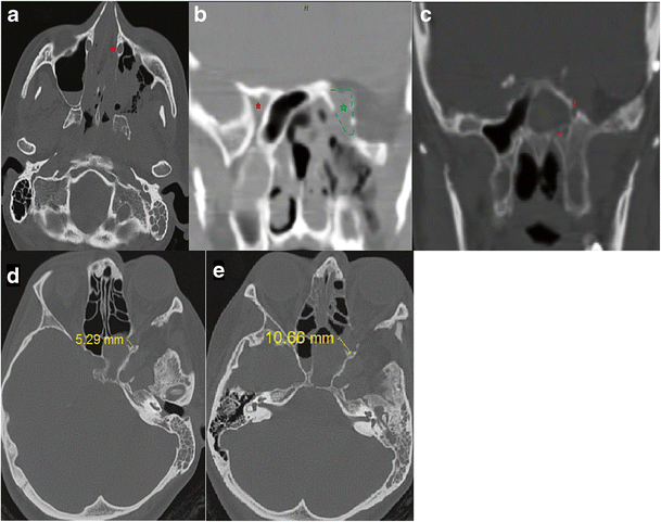 Combined endonasal and sublabial endoscopic transmaxillary approach to the pterygopalatine fossa ...