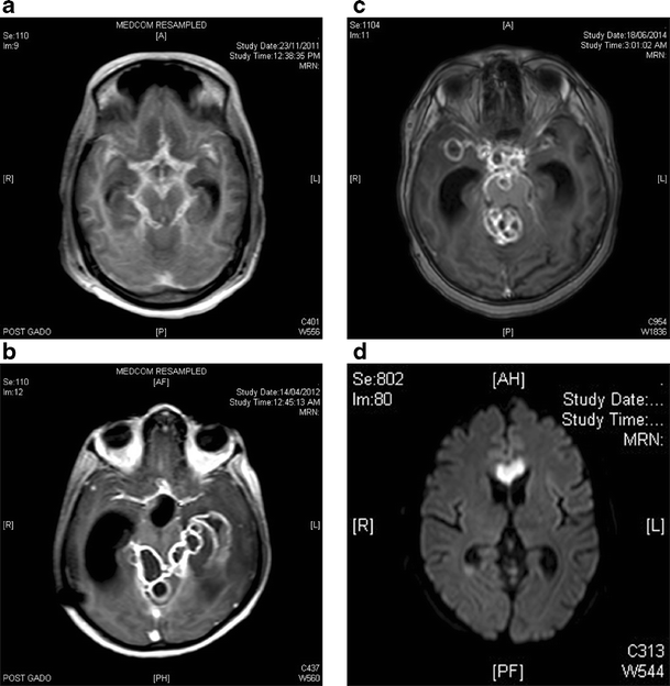 Surgery for brain tuberculosis: a review | SpringerLink