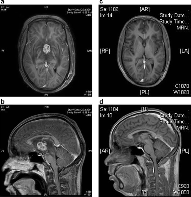 Surgery for brain tuberculosis: a review | SpringerLink