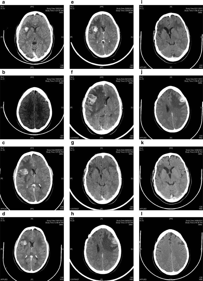 Surgery for brain tuberculosis: a review | SpringerLink