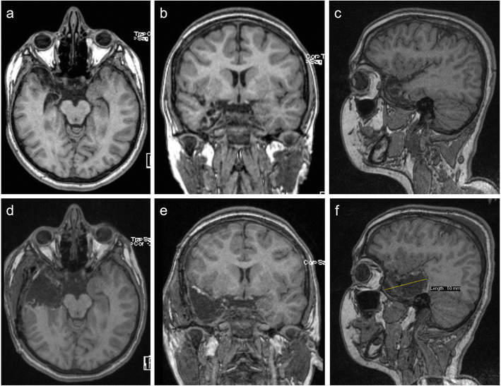 Anterior temporal lobectomy | SpringerLink